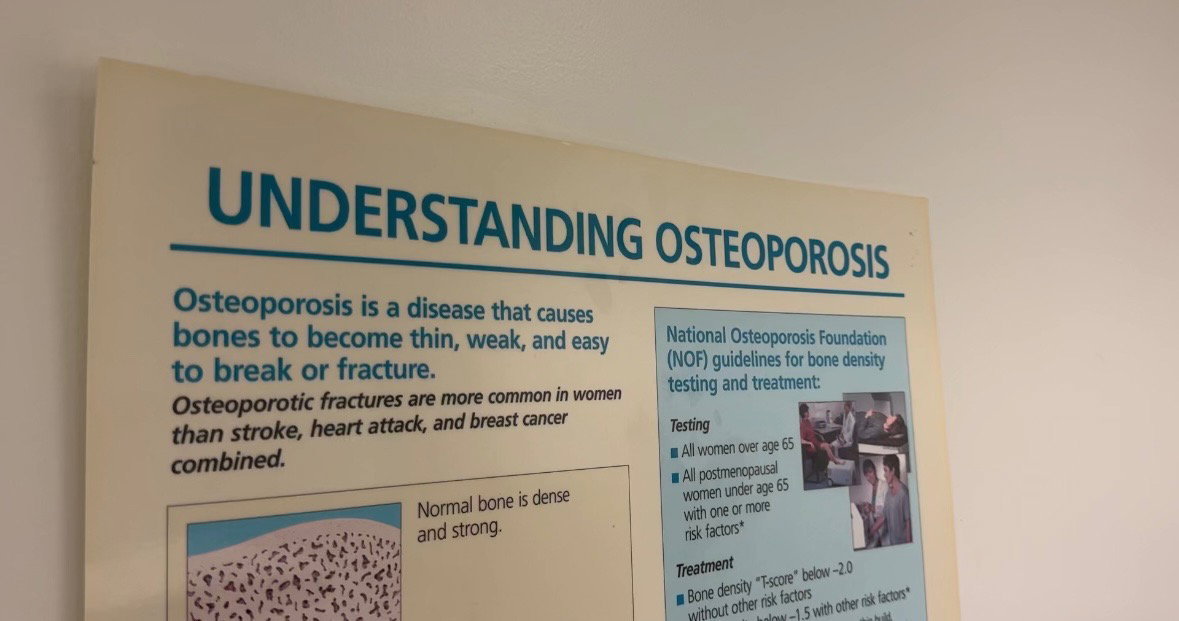 New Guidelines stress osteoporosis screenings for women 65 and older - KESQ
